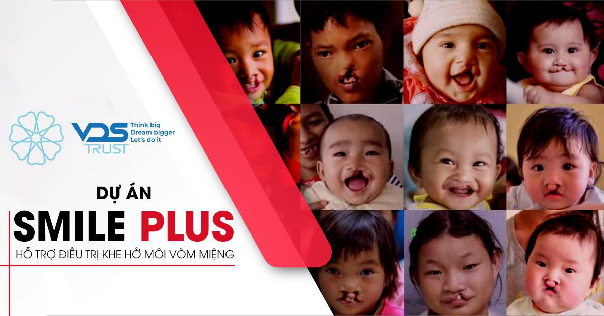Smile Plus hỗ trợ điều trị khe hở môi vòm miệng - VDS-Trust
